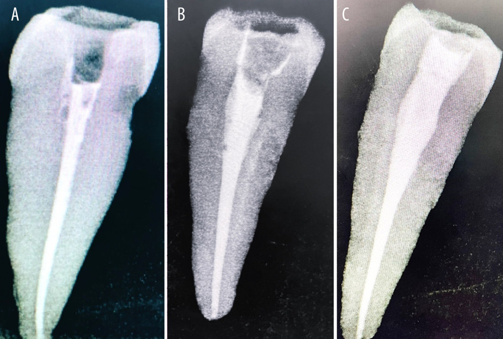 Medical Science Monitor | A Scanning Electron Microscopy Study ...