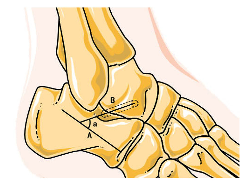 Medical Science Monitor | Anatomical Features of the Tarsal Sinus in ...