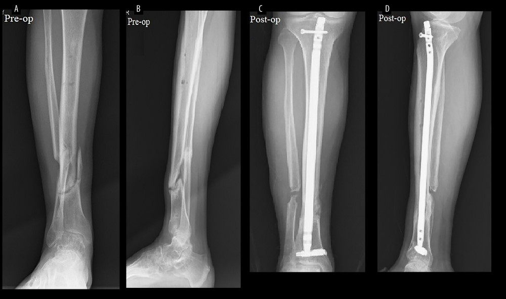 Medical Science Monitor | Improved Outcomes in Distal Tibial Non-Union ...