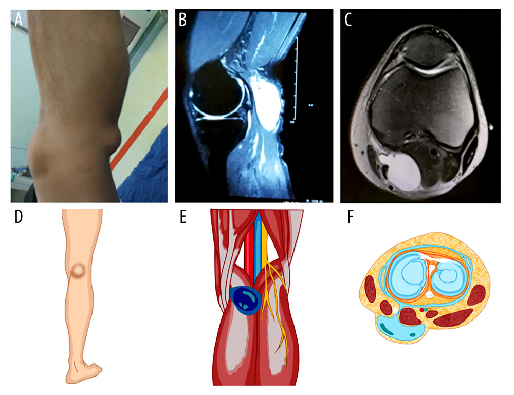 Popliteal Cyst