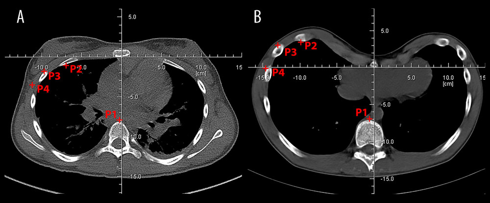 Pectus Excavatum Radiology Pectus Excavatum Workup: Laboratory