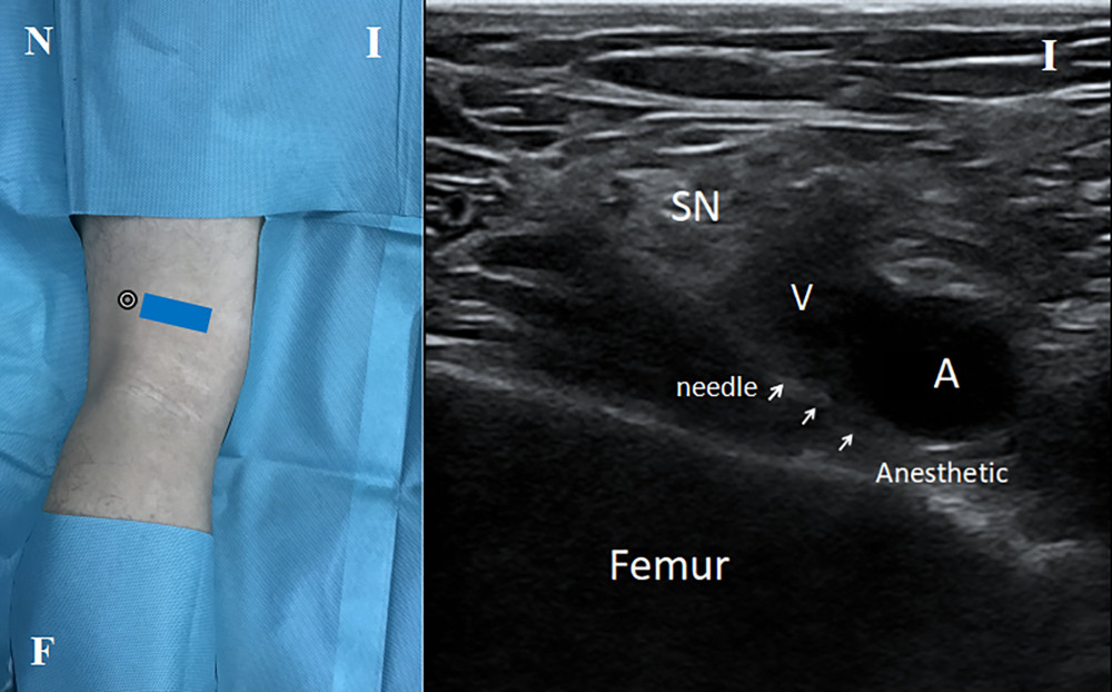 Medical Science Monitor | Enhanced Postoperative Pain Management and ...