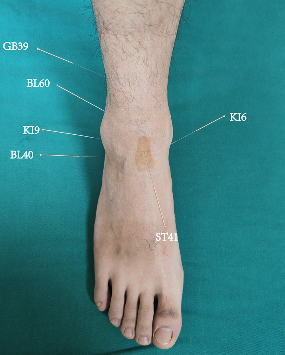 Medical Science Monitor | Comparative Efficacy of Micro-Needle-Knife ...