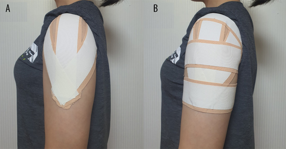 Medical Science Monitor | Effectiveness of Shoulder Taping in Treating ...