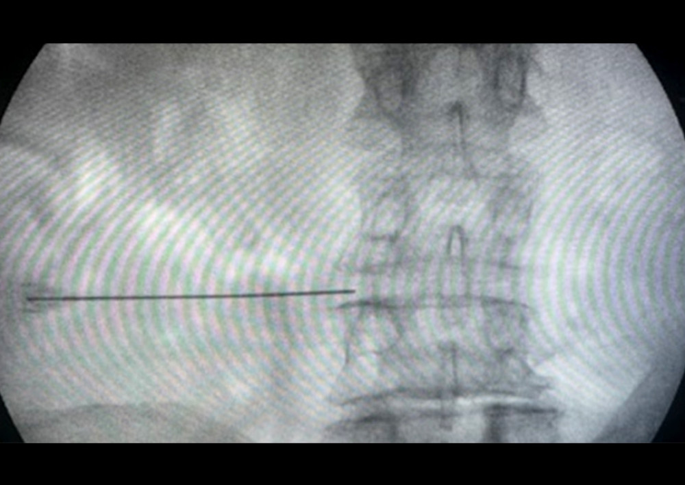 Medical Science Monitor | Effects of Ozone Disc Nucleolysis in ...