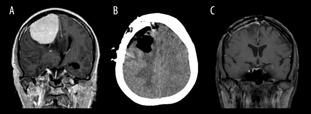 Medical Science Monitor | Impact of BrainLab VectorVision Infrared ...