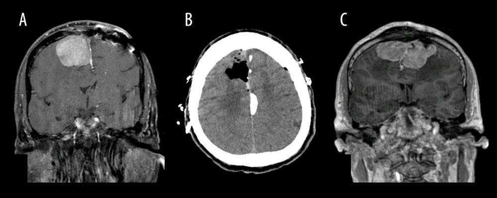 Medical Science Monitor | Impact of BrainLab VectorVision Infrared ...