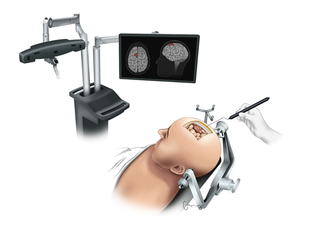 Medical Science Monitor | Impact of BrainLab VectorVision Infrared ...