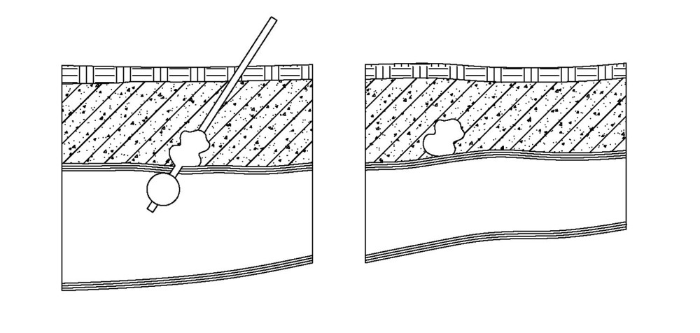 Medical Science Monitor | Advancements in Vascular Closure Devices for ...