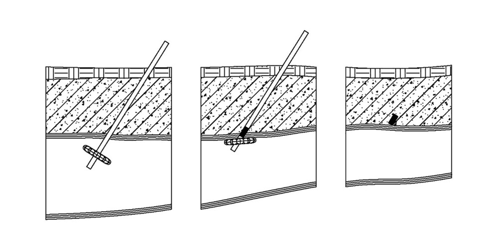 Medical Science Monitor | Advancements in Vascular Closure Devices for ...