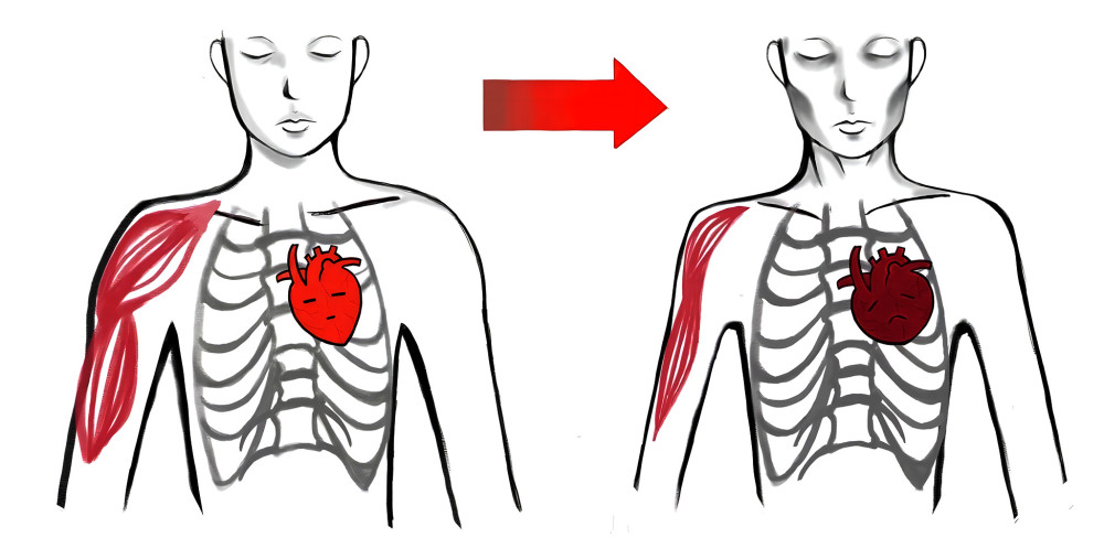 Medical Science Monitor | Targeting MuRF1 to Combat Skeletal Muscle ...